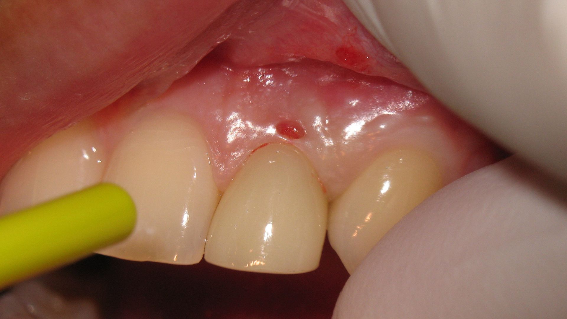 Hole In Gum Cause And Treatment At Spring Orchid Dental